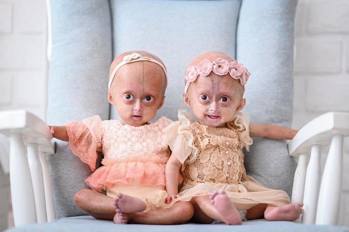 Twins Born With a Rare Benjamin Button Syndrome”: What Does The Sisters ...